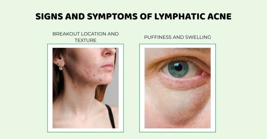 What Is Lymphatic Acne and How to Treat It? | Nature's Blast